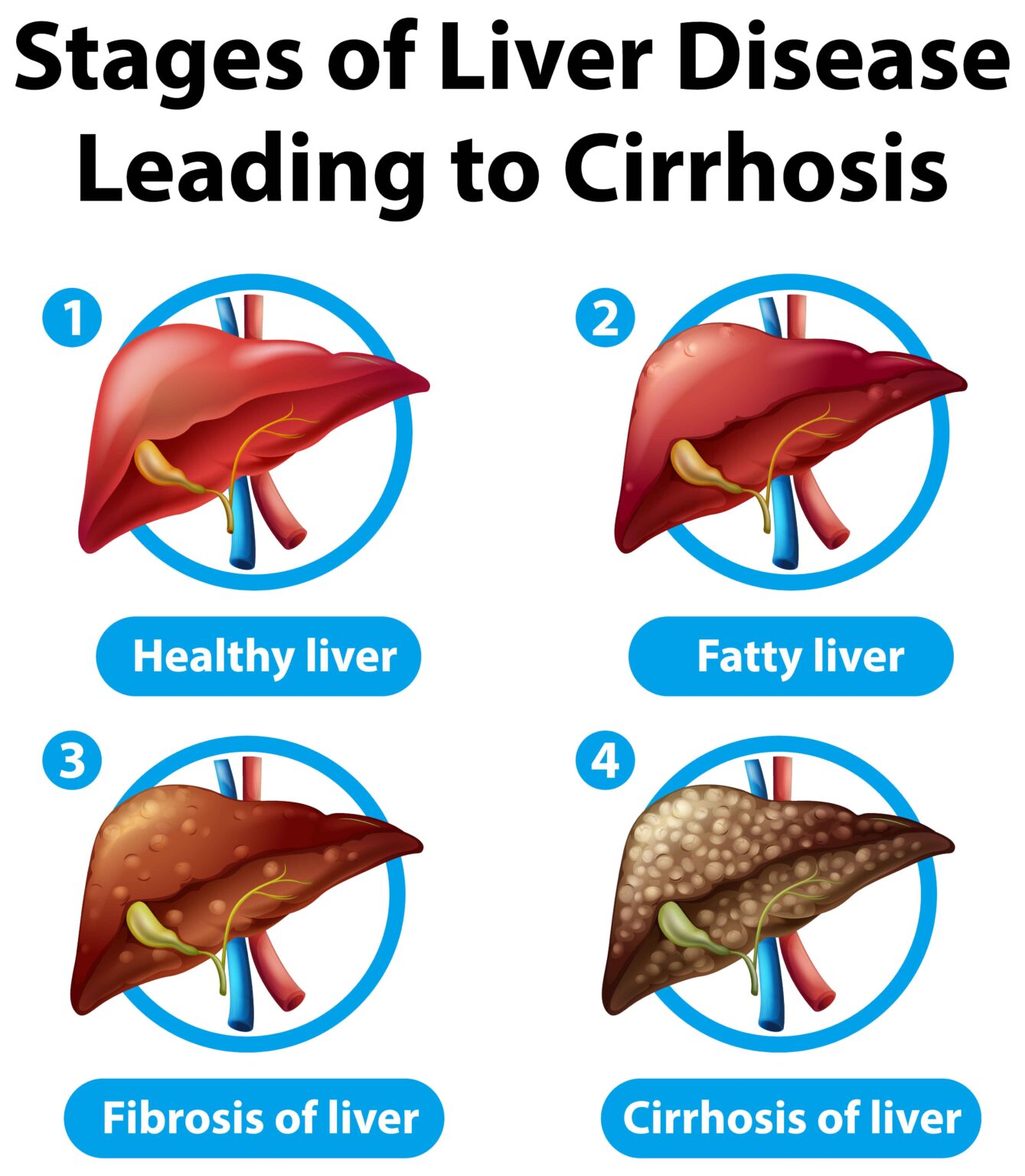 Fatty Liver Stages: Understanding Progression and Treatment